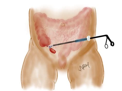 How Can Your Appendix Burst