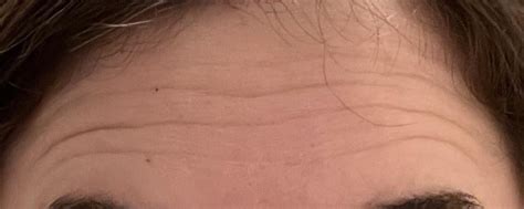 First Time Botox But Not Seeing The Results I Expected—im Currently On Day 8 And The Med Spa