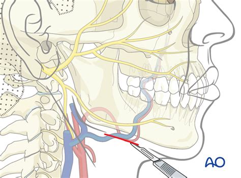 Contralateral Depressor Angularis Muscle Excision For Irreversible Paralysis Mouth Lower Lip