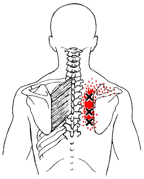 Rhomboid Trigger Points And Referred Pain Patterns Trigger Point Self Help