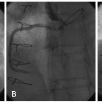 Schematic Illustration Of The Cabrol Procedure Showed That After Download Scientific Diagram