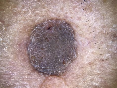 Seborrheic Keratosis Dermoscopy Stock Image C0563230 Science
