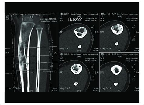 Ct Of Tibia In 2009 Showing An Expansile Intracortical Mixed Lytic And Download Scientific
