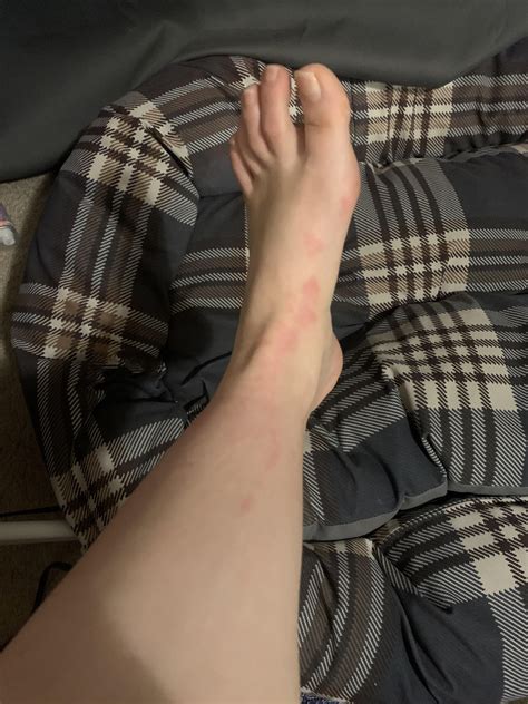 I Get This Rash On My Feet Almost Every Time I Shower Does Anyone Else Have Shower Triggered
