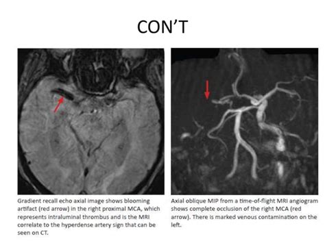 Imaging Ischemic Infarction Pptx