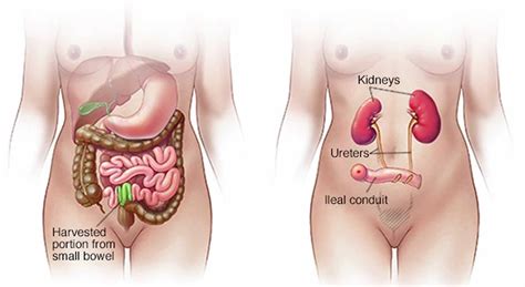 Radical Cystectomy With Ileal Conduit And Radical Cystectomy With Neobladder