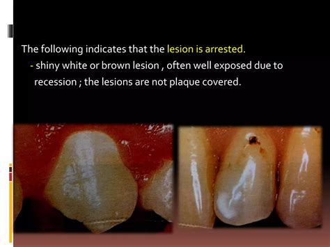 Management Of Class V Caries Pptx