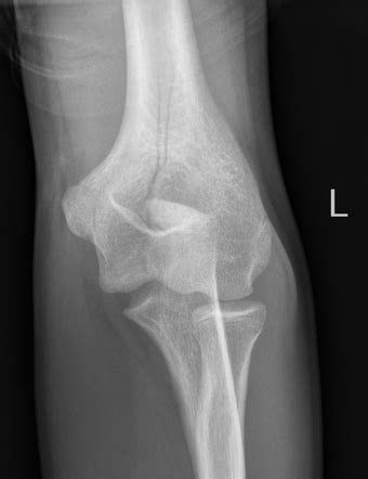 Longitudinal Distal Humeral Fracture Adolescent Radiology Case Radiopaedia Org