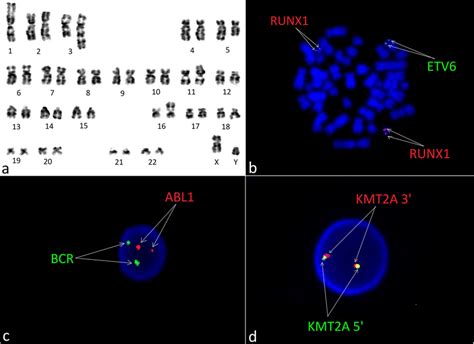 Cytogenetic Analysis Of Bone Marrow Cells At Diagnosis Of T NHL In