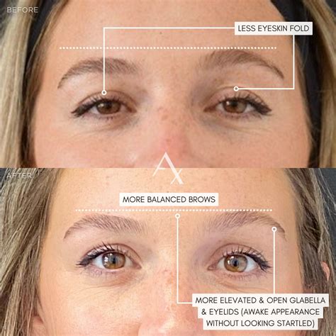 Botox Gone Wrong Before And After