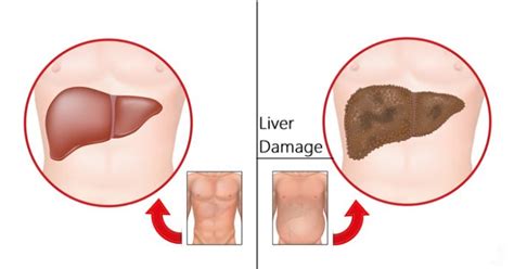 Повреждение печени 7 ранних предупреждений которые вы не должны игнорировать