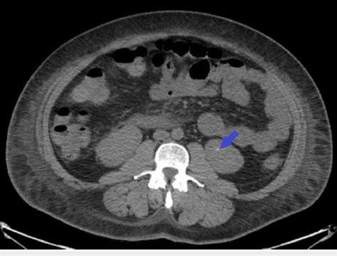 Ct Abdomen Showing Punctate Left Renal Lower Pole Calcification Blue Download Scientific