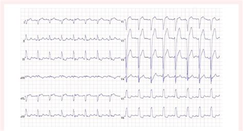 Electrocardiogram After 6 Months Shows A Sinus Rhythm With Left Bundle Download Scientific