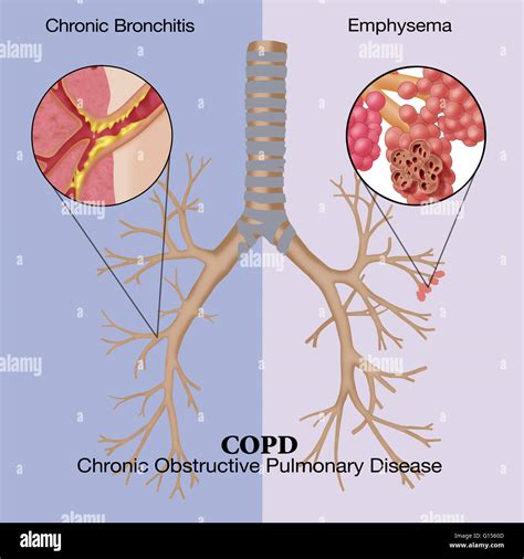 Copd Chronic Obstructive Pulmonary Disease Pathophysi