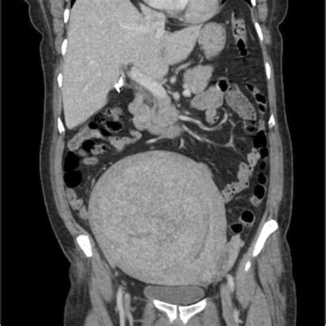 A Slightly Hypocellular Bone Marrow With Trilineage Hematopoiesis