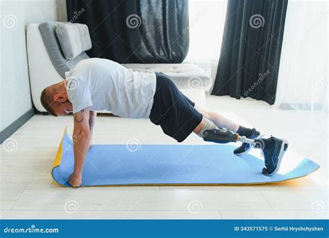 Man Amputee With Prosthetic Leg Disability On Transfemoral Leg Prosthesis Artificial Device