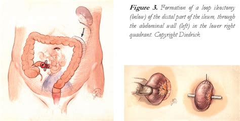Figure 3 From Early Closure Of A Temporary Ileostomy After Rectal Resection For Cancer