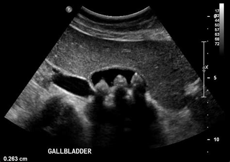 Gallbladder Ultrasound Stones