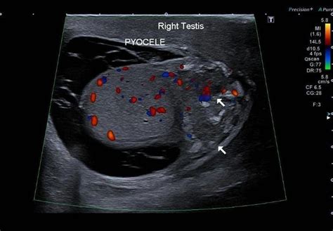 Last Chitumba On Linkedin Epididymo Orchitis With Associated Pyocele