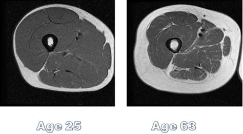 Sarcopenia A Loss Of Muscle Mass And Function