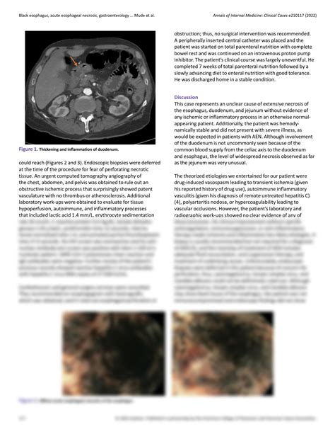 Solution Diffuse Necrosis A Rare Case Of Idiopathic Black Esophagus