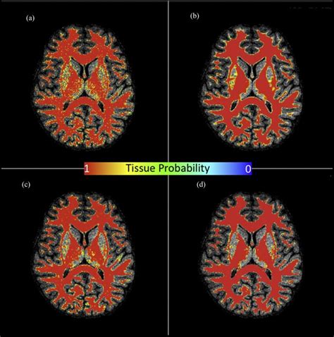 The Joint Simulation Results For Multi Modal Brain Image Table 3 The