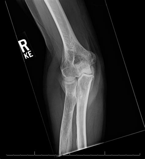 Olecranon Fracture Radiology Case