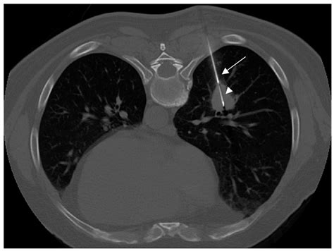 Ct Guided Biopsy Dr Ankit