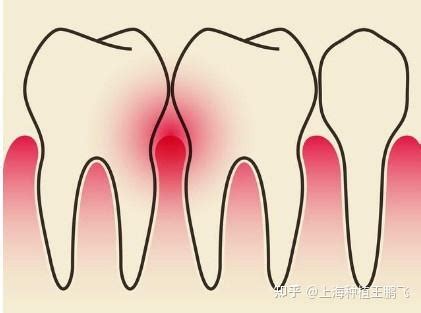 种植体周围炎该如何预防 知乎