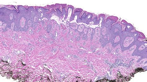 Acantholysis Histology