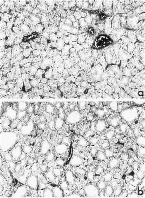 A Light Micrograph Illustrating Diffuse Hyperplasia Of The Thyroid Download Scientific
