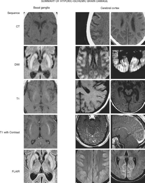 Hypoxic Ct Scan