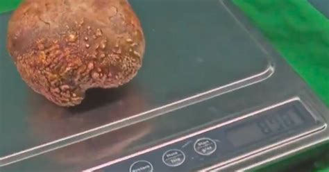 Video Van De Dag Grootste Niersteen Ooit Van Ruim 13 Centimeter