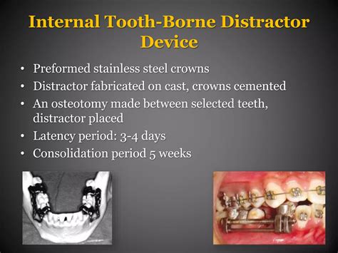 Distraction Osteogenesis In Orthodontics Pptx