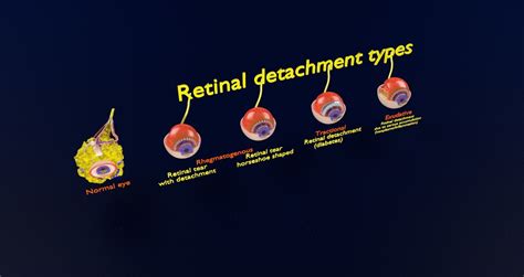 Retinal Detachment Types Eye 3d Model Cgtrader