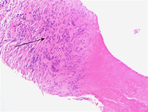 High Power Image Hande ×40 Showing Histiocytes Arrow Next To The Download Scientific Diagram