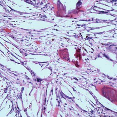 Cholesterol Granuloma 40x Magnification Download Scientific Diagram