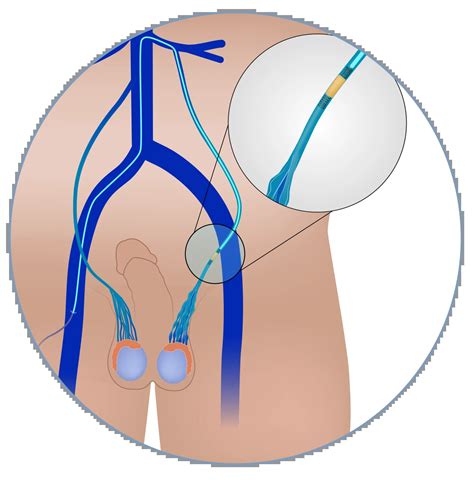 Varicocele Embolization Colorado Advanced Endovascular