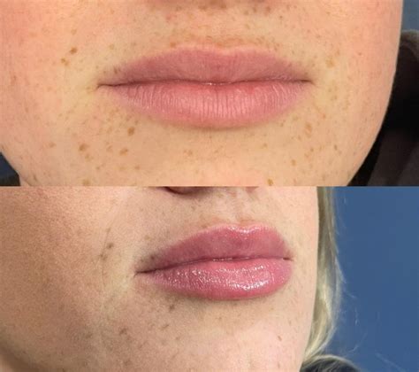 Upper Lip Botox Before And After Botox Lip Pop Juverne
