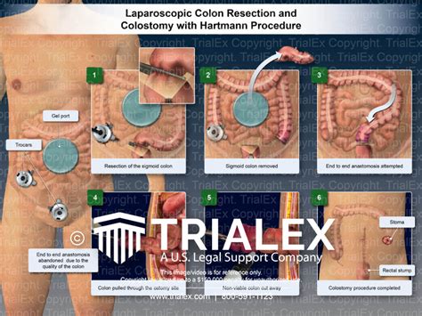 Laparoscopic Colon Resection And Colostomy With Hartmann Procedur