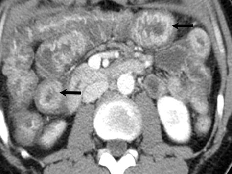 Vasculitis In The Emergency Room The Pivotal Role Of Imaging In
