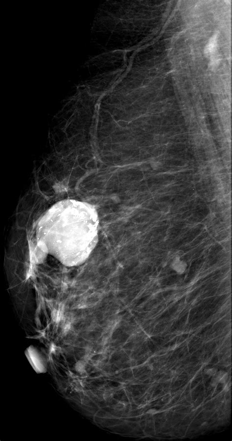 Mass Detection Object Detection Dataset And Pre Trained Model By Breast