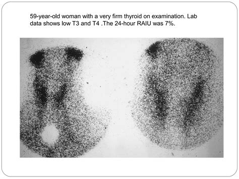 Radionuclide Imaging Thyroid And Parathyroid Ppt