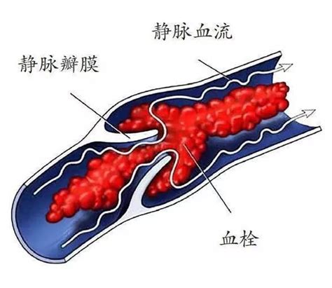 静脉血栓遗传风险检测 上海善准医疗科技有限公司