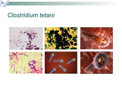 Cl Tetani Cl Difficile Ppt Digestive Disorders Diseases And
