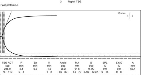 Thromboelastogram Ii Anesthesia Key