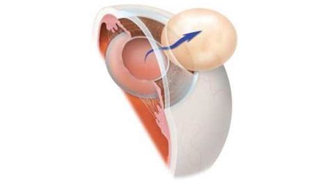 Intracapsular Cataract Extraction Meaning Benefits And Risks