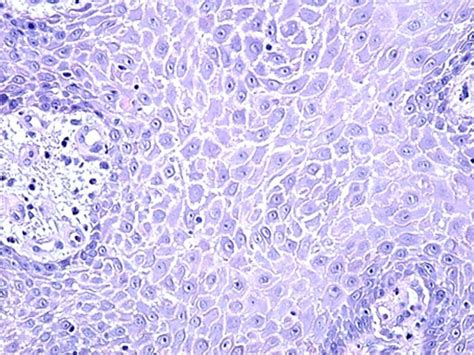Image Of Gingivitis With Areas Of Papillary Necrosis And Download