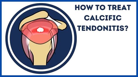 Healing Calcific Tendonitis At Martin Horvath Blog