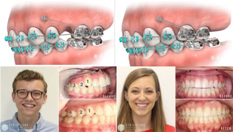 Orthodontics In Spanish Fort Bay Minette Foley Orthodontics